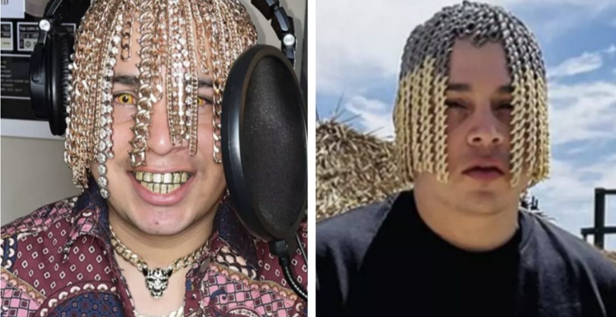 Rapper enfrenta riscos graves após implantar correntes de ouro na cabeça