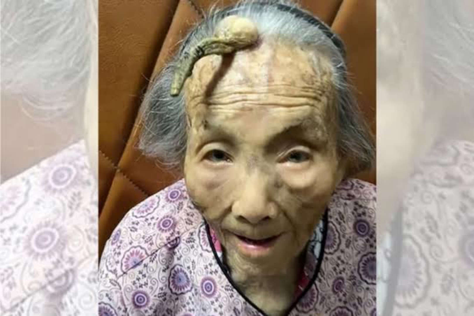 Idosa de 107 anos com chifre? Condição rara viraliza na web